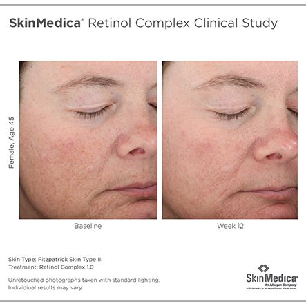 Before & After – Retinol Complex 1.0 – Allergan Brandbox