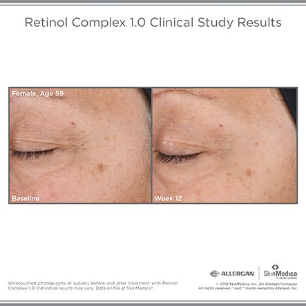 Before & After – Retinol Complex 1.0 – Allergan Brandbox