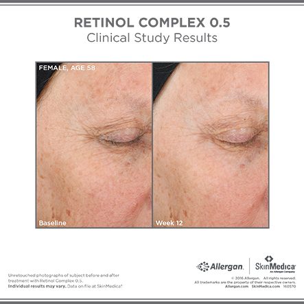Before & After – Retinol Complex 0.5 – Allergan Brandbox